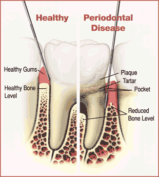 What is Periodontal (Gum) Disease? – Farrokh Bashiri, DDS